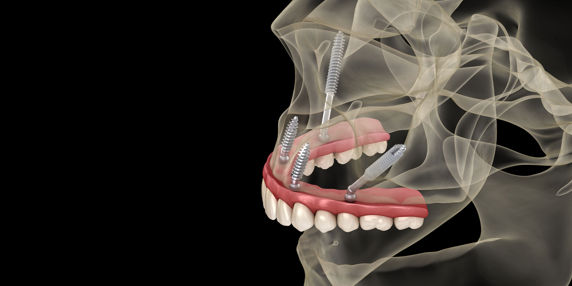 Zygomatic Implants | Fallbrook & Torrance, CA | ADHP