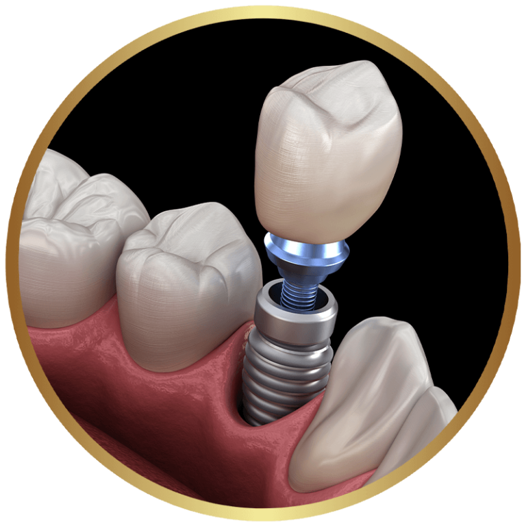 Dental Implants Torrance 2 | American Dental Health Providers