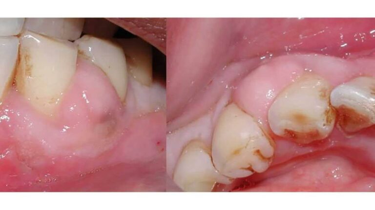 Tooth Pain When Chewing: 7 Possible Causes (And What to Do Next ...