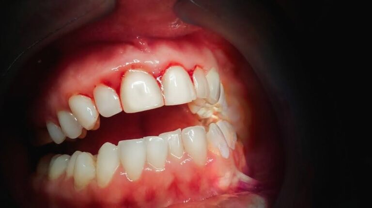 Tooth Pain When Chewing: 7 Possible Causes (And What to Do Next ...