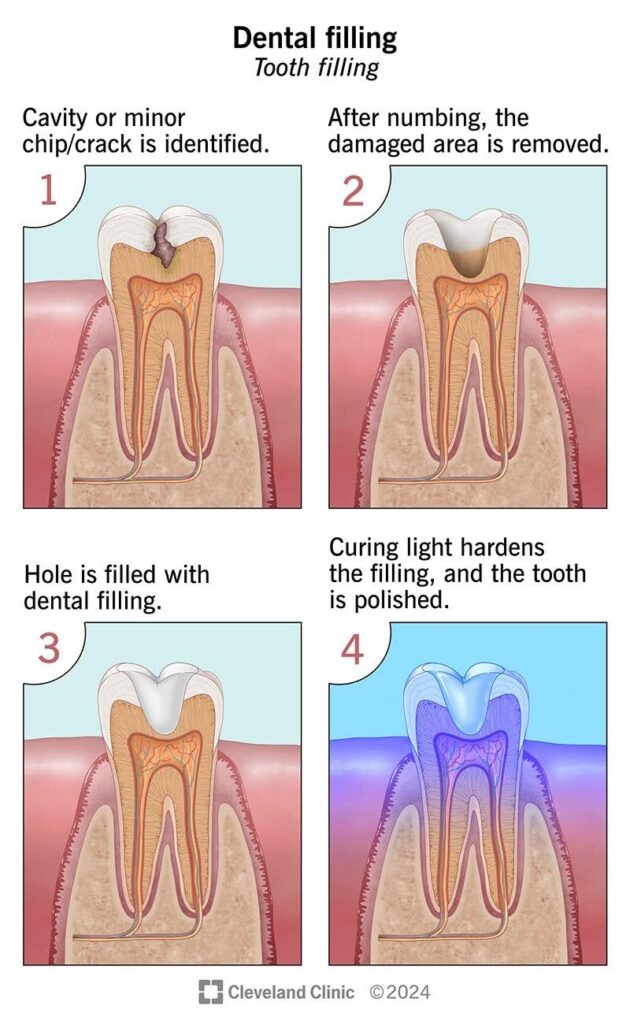 Tooth Pain When Chewing: 7 Possible Causes (And What to Do Next ...